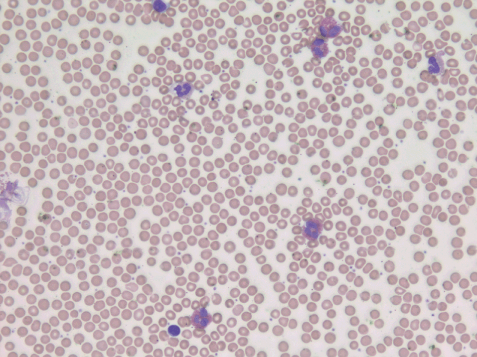 Peripheral Blood Smear Review (Chapter 1) - Atlas of Pediatric ...