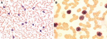 Peripheral Blood Smear Review (Chapter 1) - Atlas of Pediatric ...
