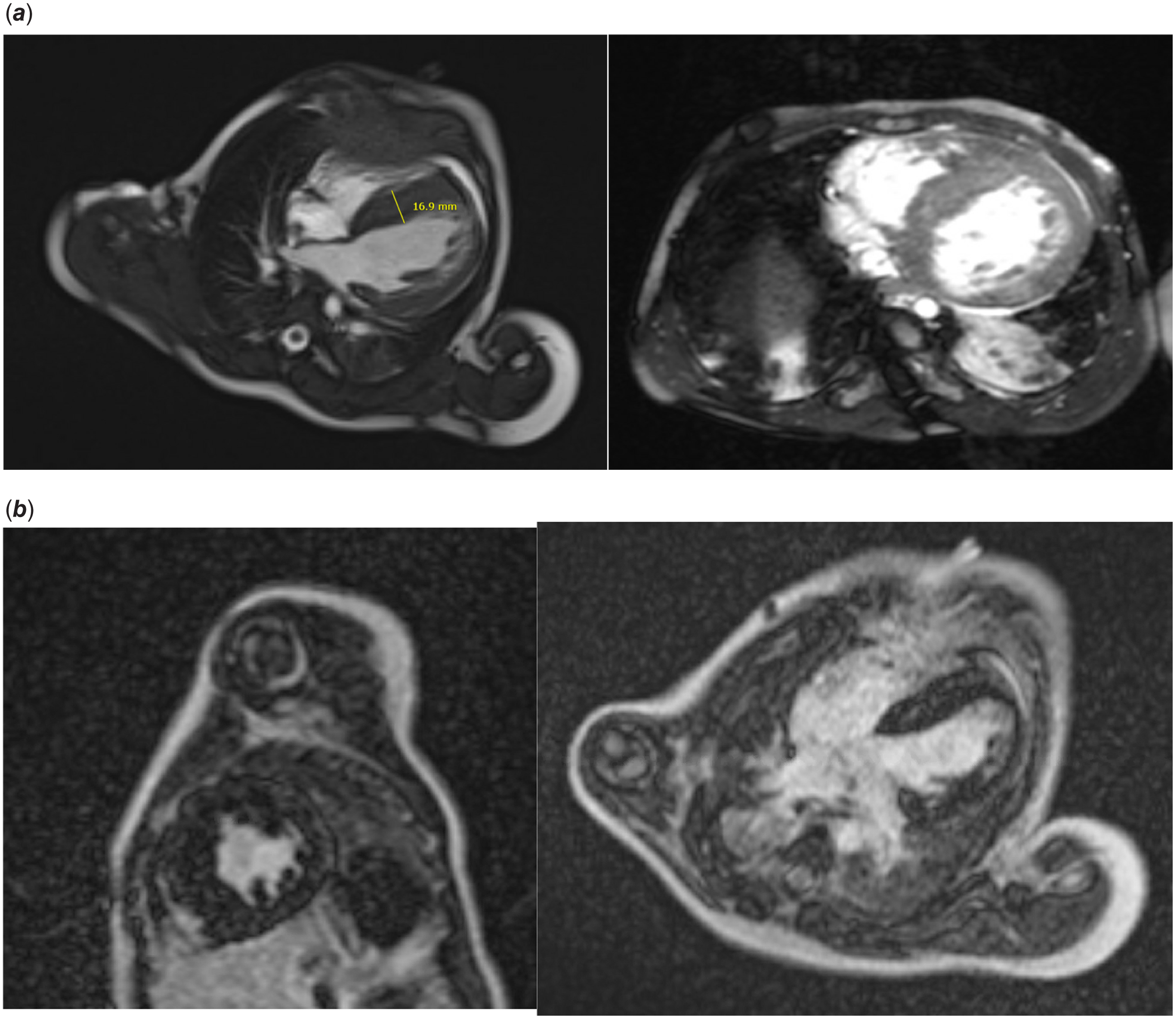 Aborted sudden cardiac death and a severe form of hypertrophic ...