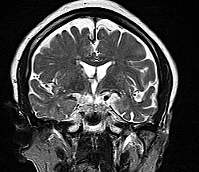 Semantic dementia: a complex and culturally influenced presentation ...