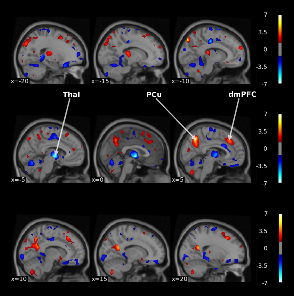 Development and validation of a multimodal neuroimaging biomarker for ...