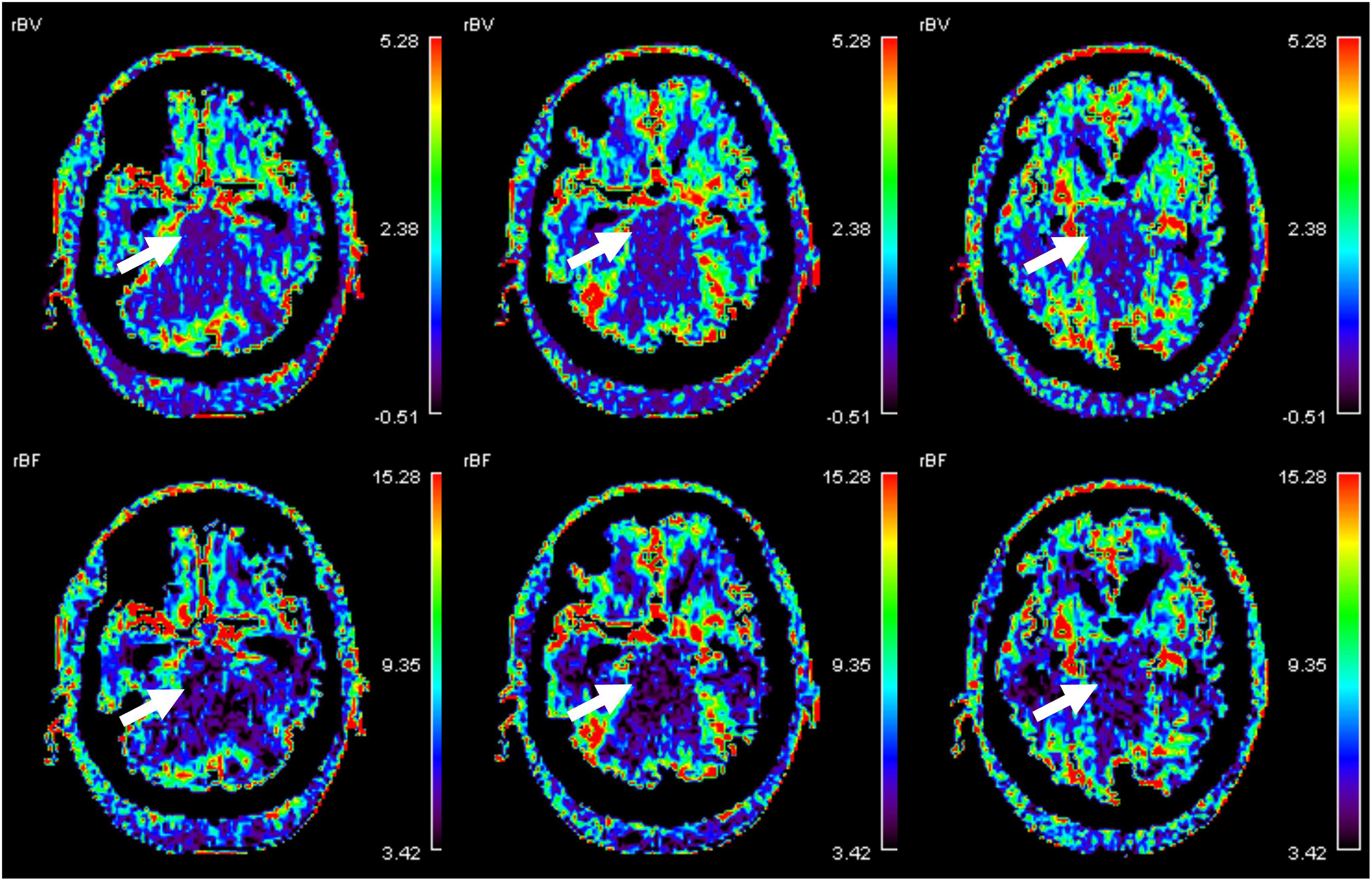 Computed Tomography Perfusion for the Diagnosis of Brain Death: A ...