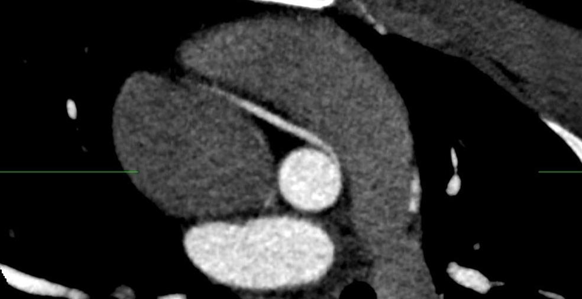 High takeoff of the right coronary artery by echocardiography: normal ...