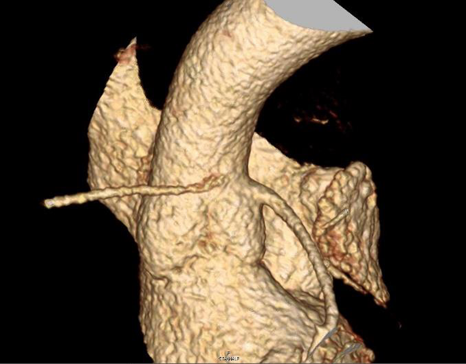 High takeoff of the right coronary artery by echocardiography: normal ...