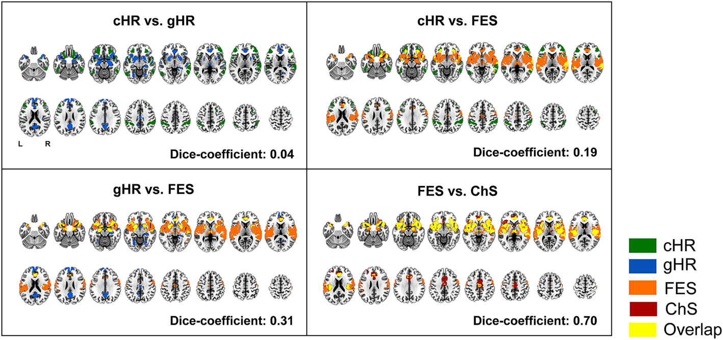 Brain structural damage networks at different stages of schizophrenia ...