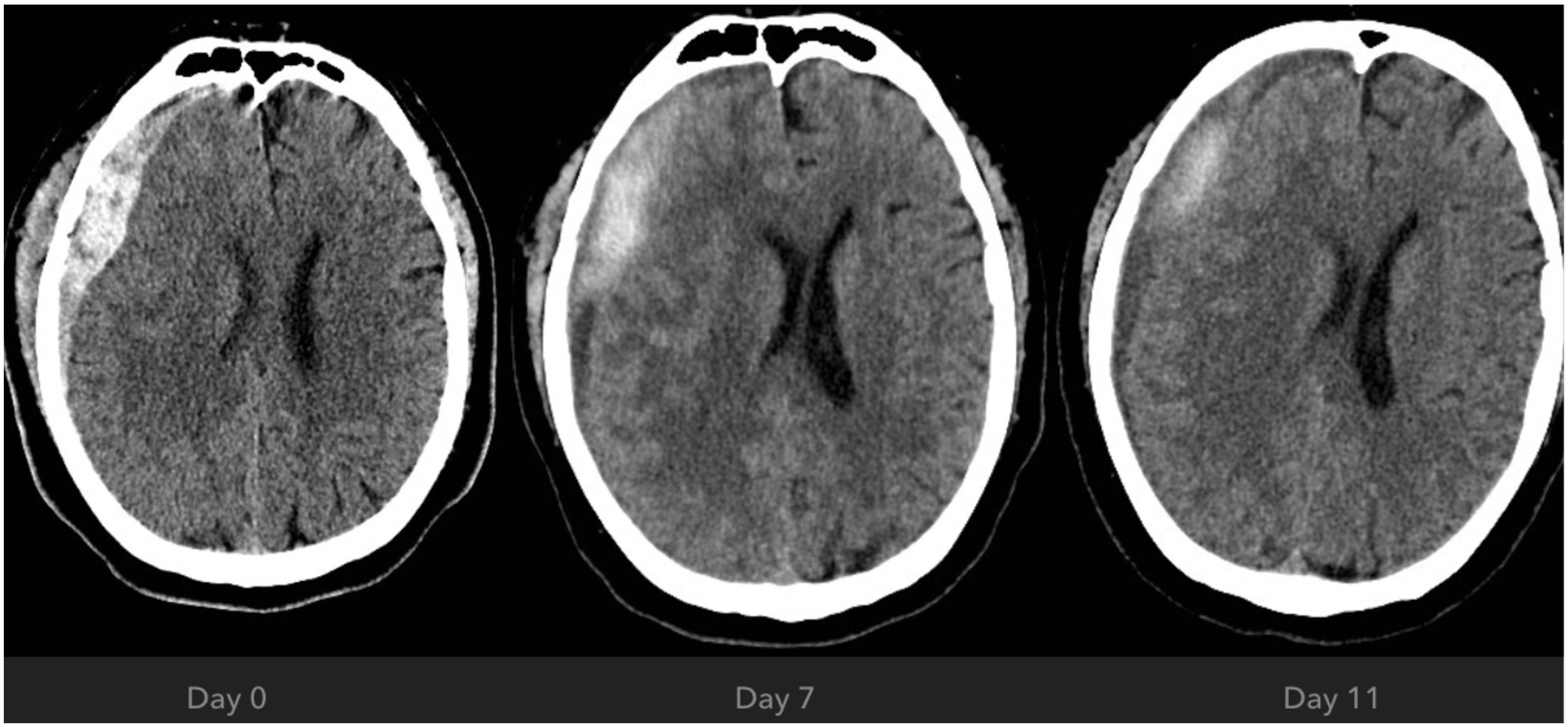 Imaging for Management of Chronic Subdural Hematoma: A Review ...