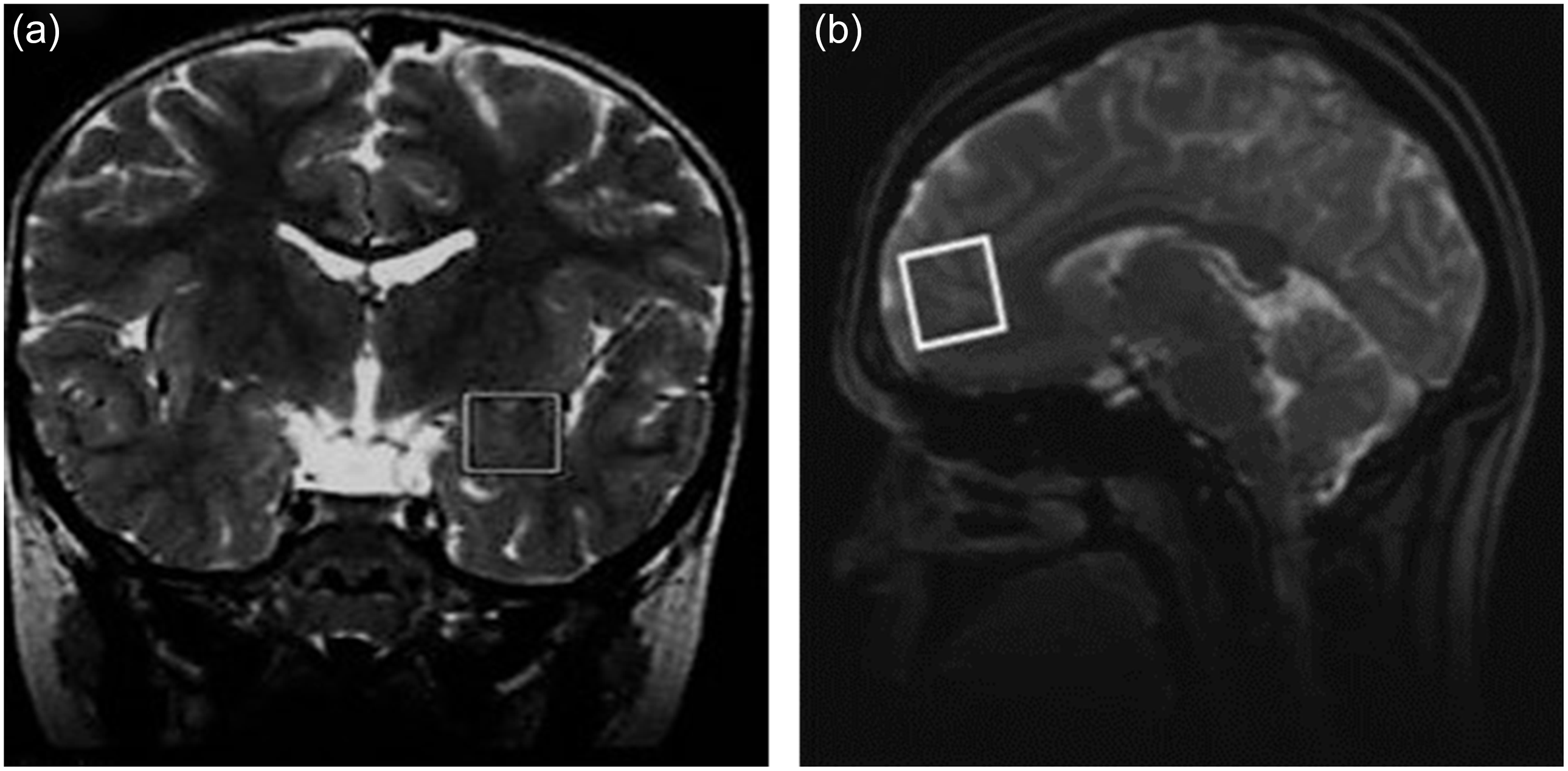 Comparison of neuro-metabolites in borderline and antisocial ...