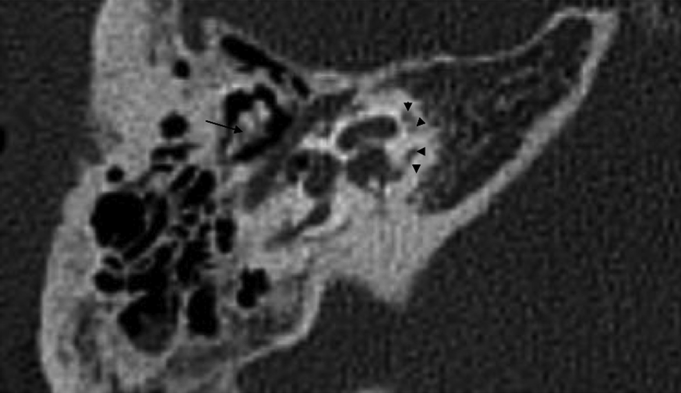 Computed tomography features of luetic osteitis (otosyphilis) of the ...