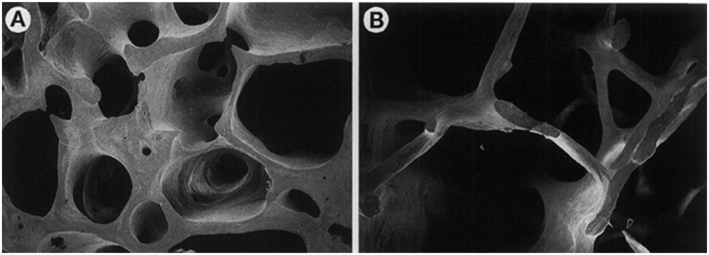 Osteoporosis (Chapter 1) - Clinical Gynecology