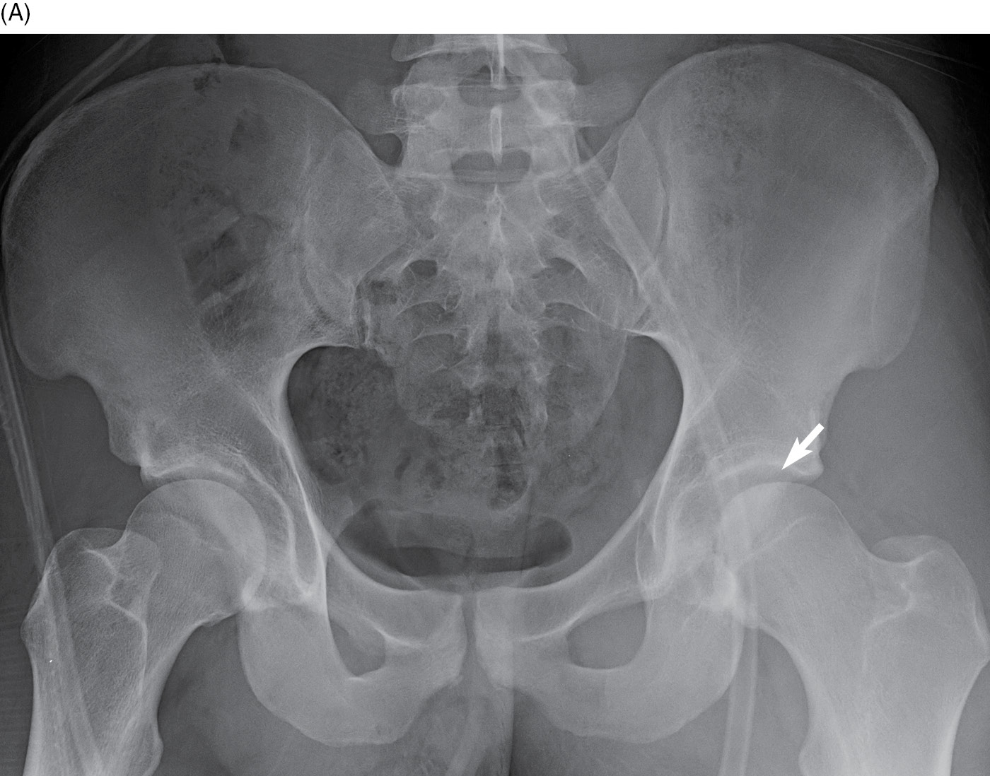 Male Broken Pelvis X Ray