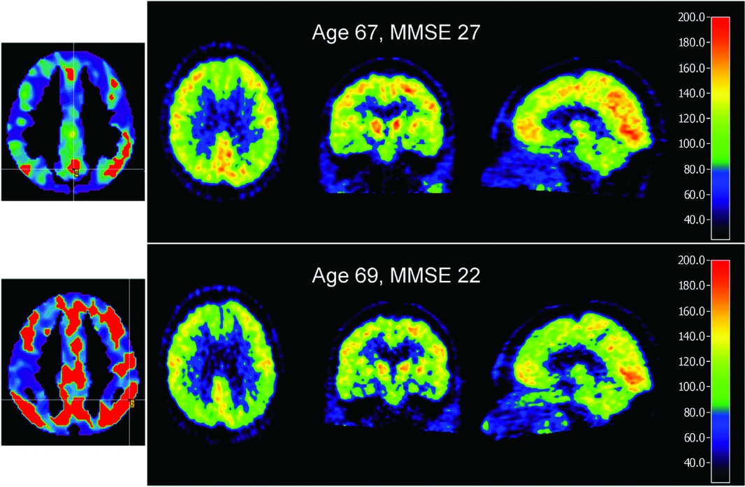 Perfusion SPECT and FDG-PET | International Psychogeriatrics ...