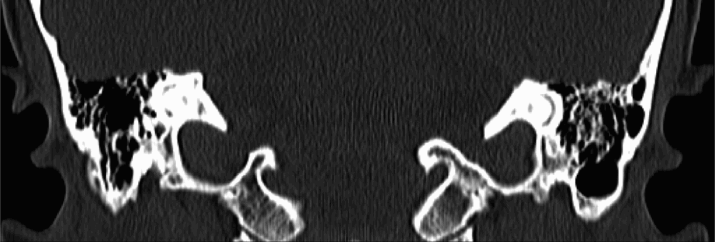 ‘Honeycomb’ tegmen: multiple tegmen defects associated with superior ...