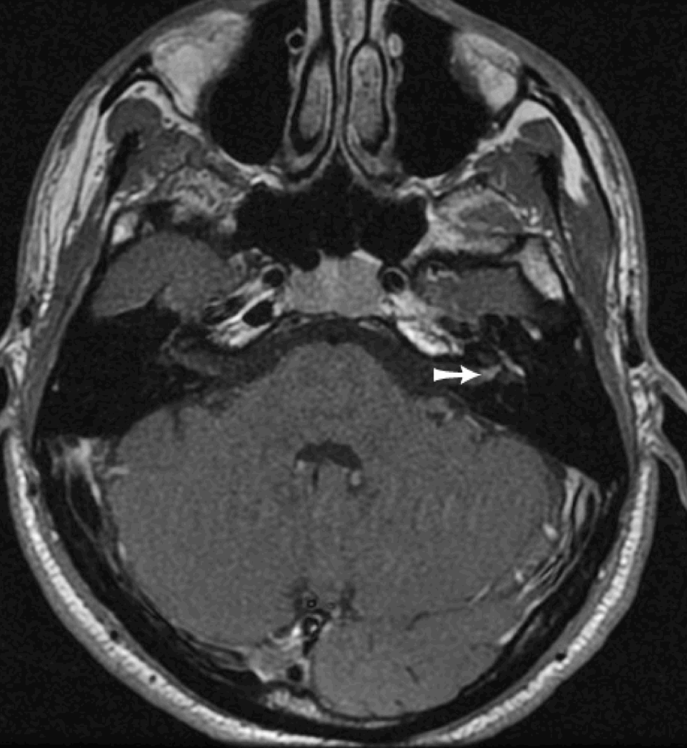 Facial nerve decompression for idiopathic Bell's palsy: report of 13 ...