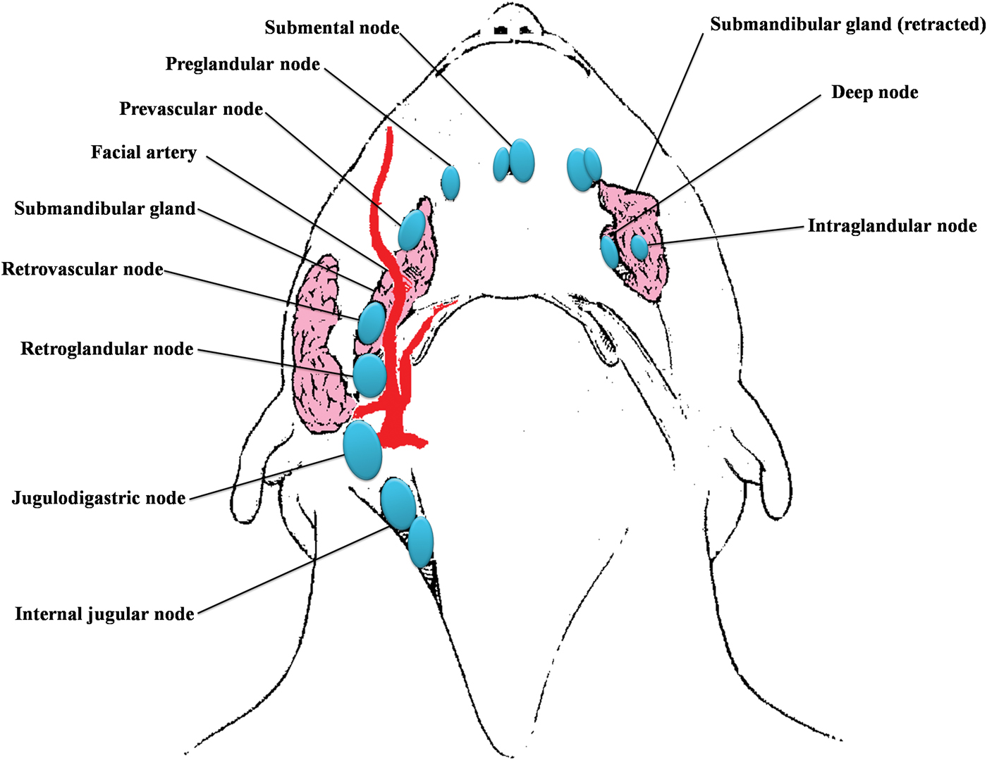 Oral cavity squamous cell carcinoma metastasis to the submandibular ...