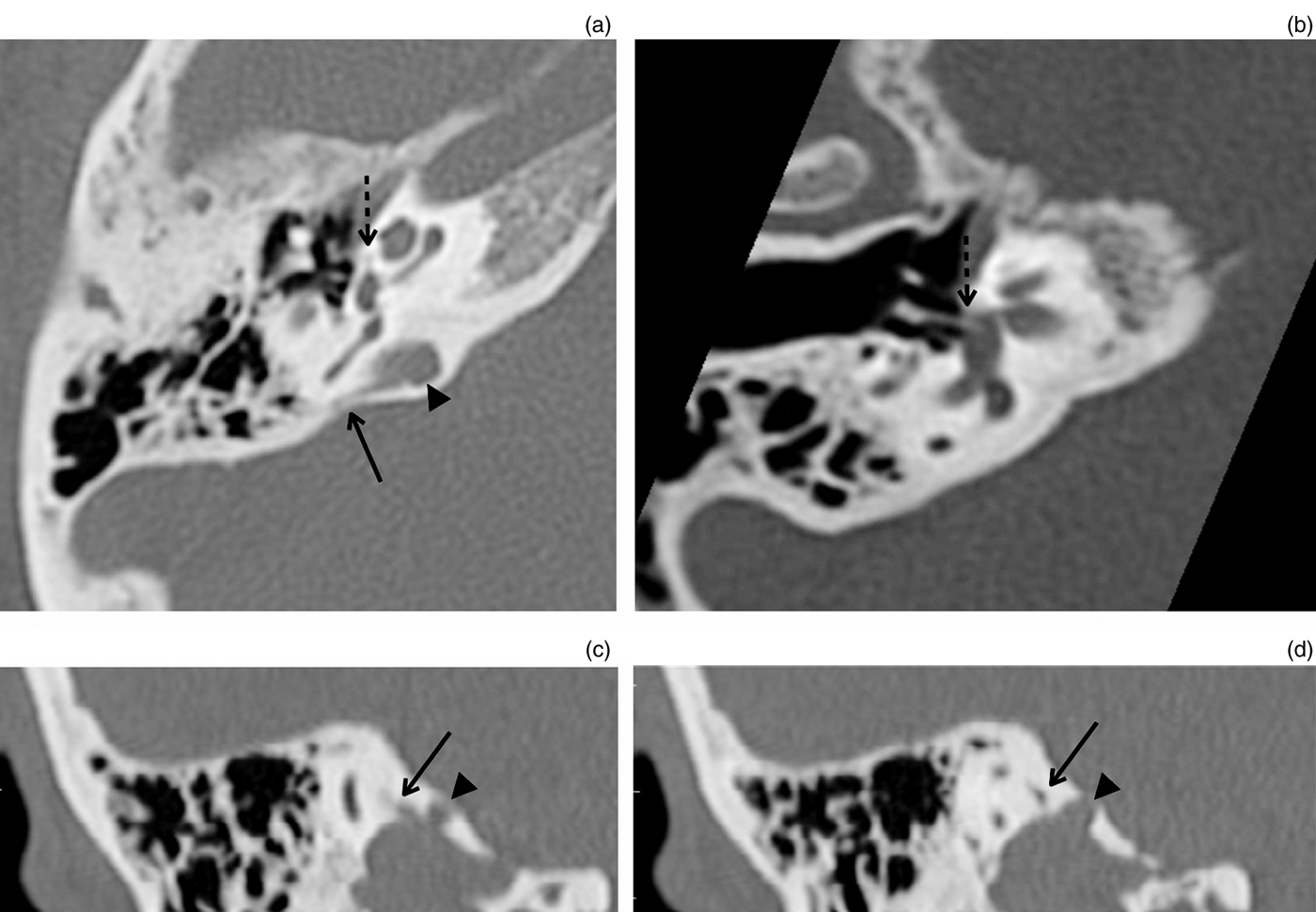 Jugular bulb diverticulum dehiscence towards the vestibular aqueduct in ...
