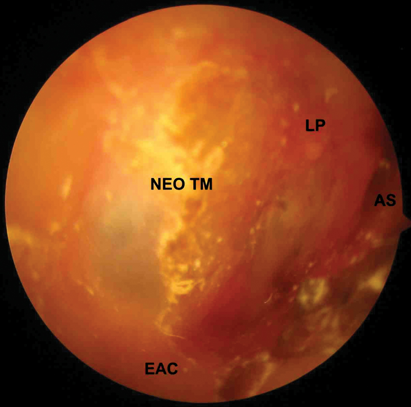 Comparative study of efficacy of graft placement with and without ...