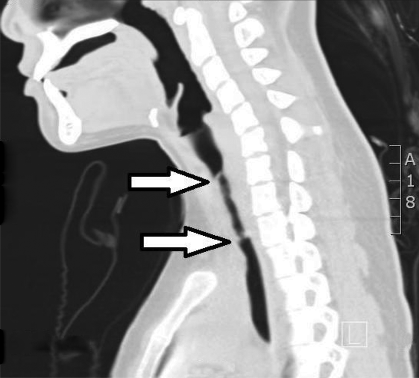Iatrogenic tracheal flap mimicking tracheal stenosis with resultant ...