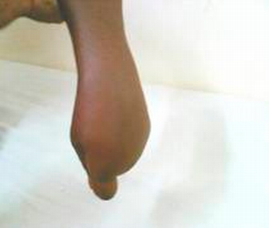 A rare case of psycho-flexed hand | Acta Neuropsychiatrica | Cambridge Core