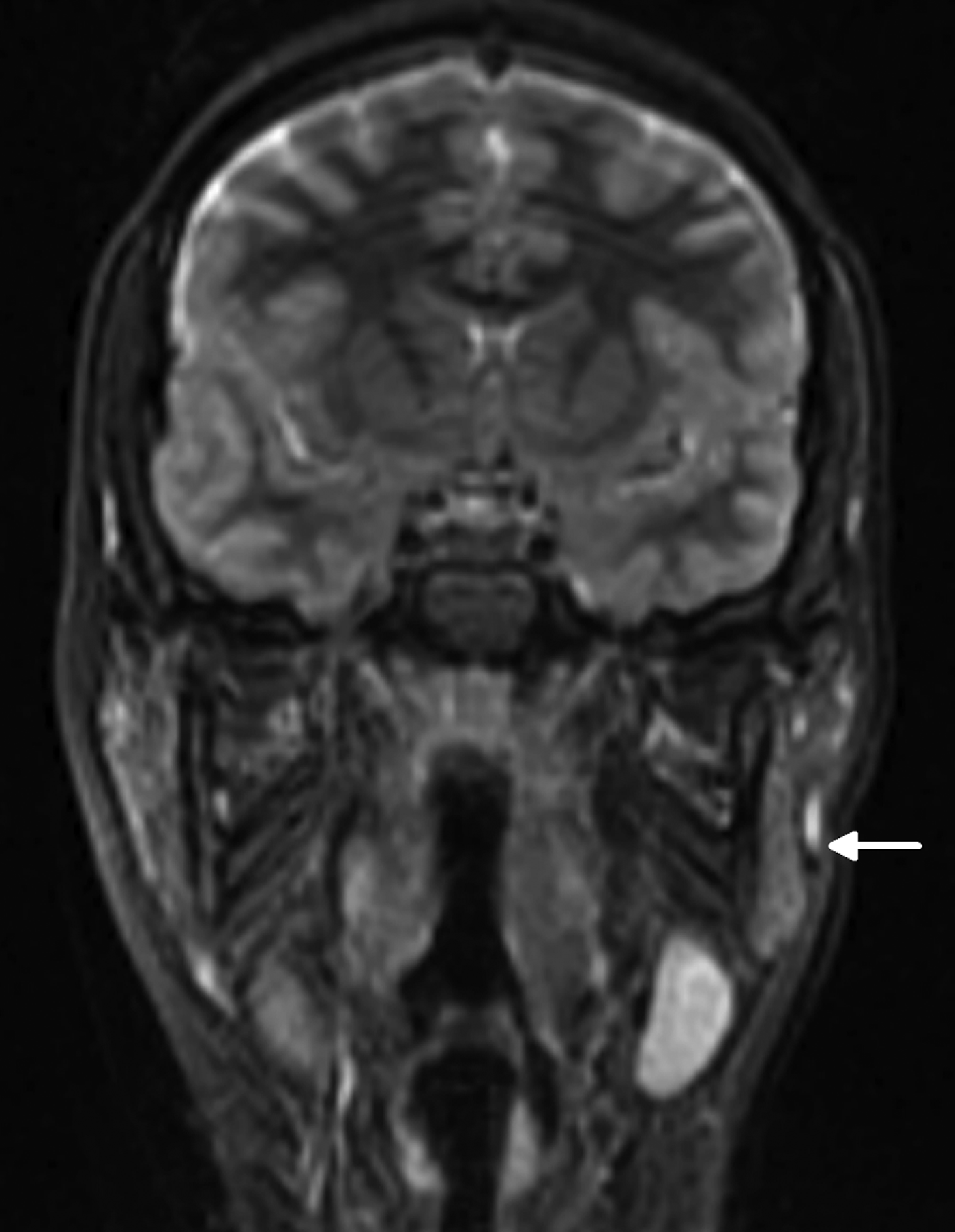 First branchial arch abnormality: diagnostic dilemma and excision with ...