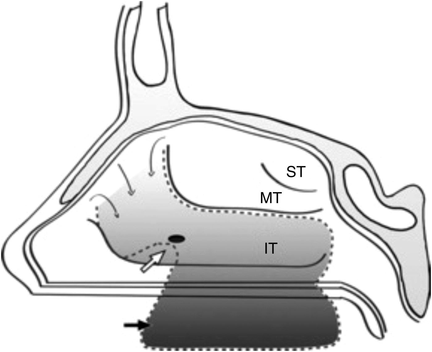 Technical nuances of commonly used vascularised flaps for skull base ...