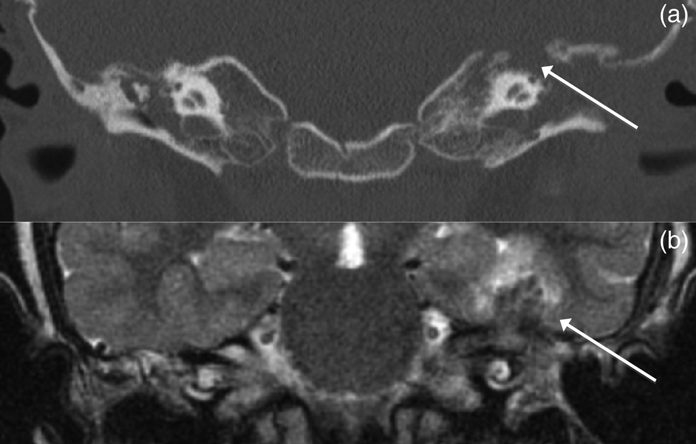 Otomastoiditis caused by non-tuberculous mycobacteria: report of 16 ...
