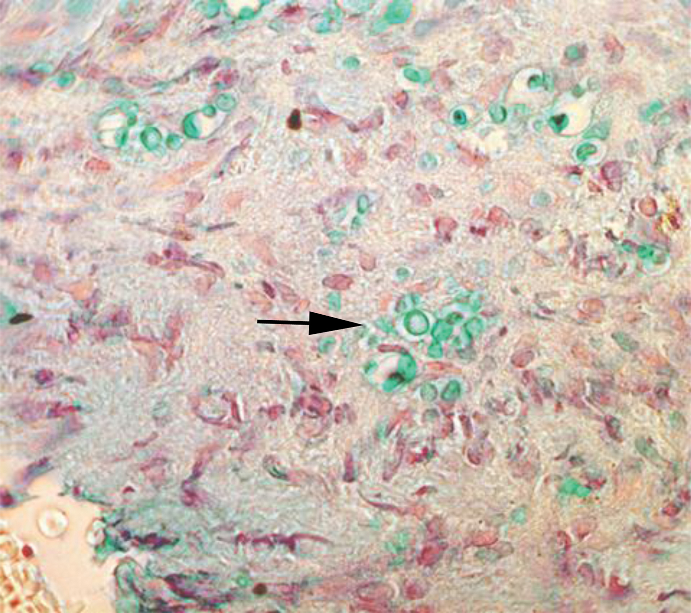 Cryptococcal infection of the larynx: case report | The Journal of ...