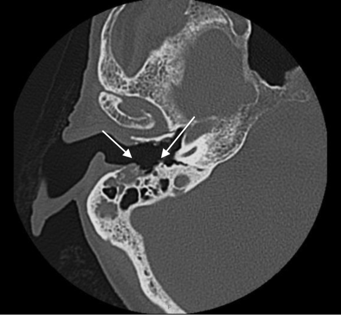Bisphosphonate-associated osteonecrosis of the external auditory canal ...