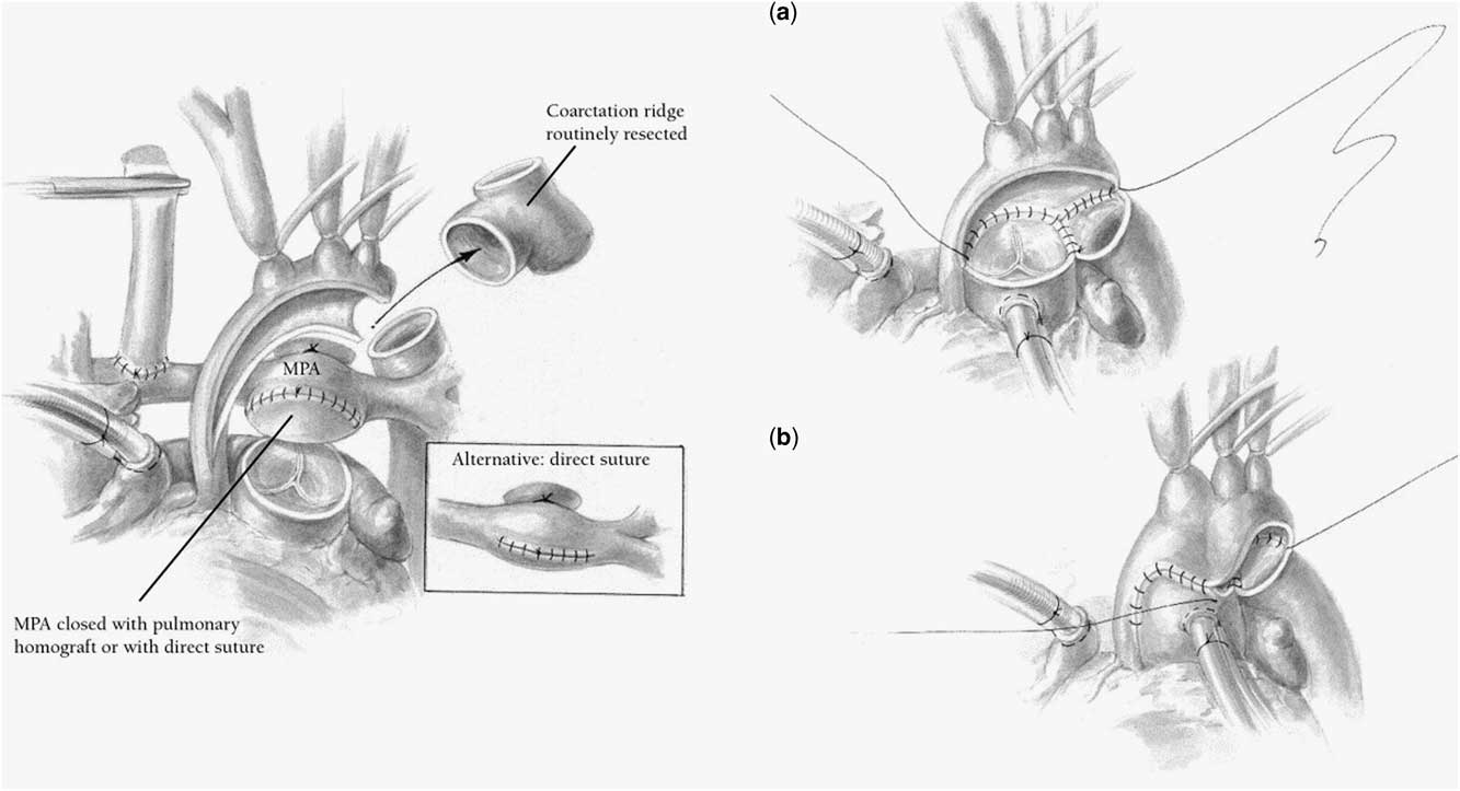 Neonatal surgical reconstruction and peri-operative care for ...
