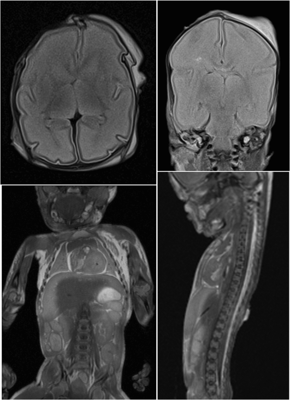 THE LESS-INVASIVE PERINATAL AUTOPSY: CURRENT STATUS AND FUTURE ...