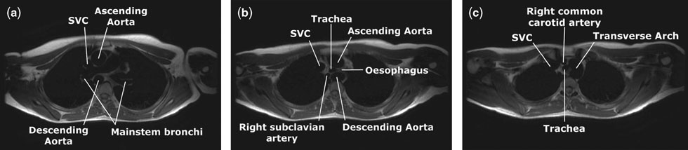 Left aortic arch with right descending aorta and right arterial ...