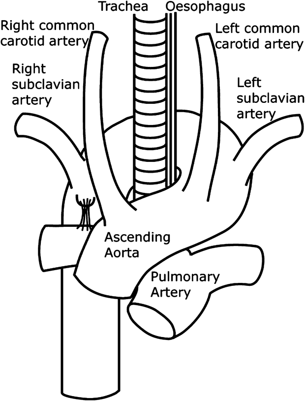 Left aortic arch with right descending aorta and right arterial ...