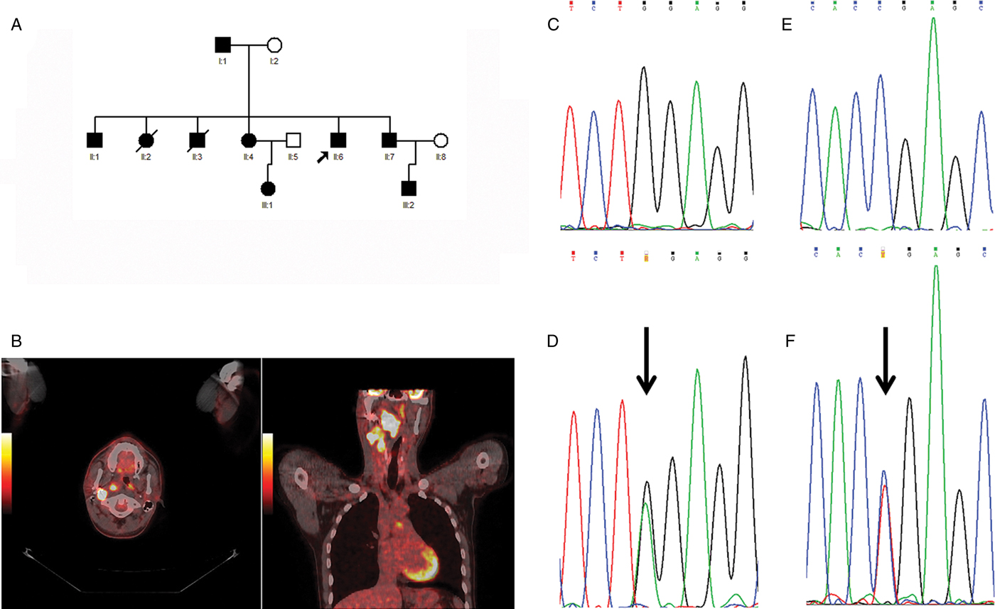 Malignant phenotype and two SDHD mutations in a family with ...