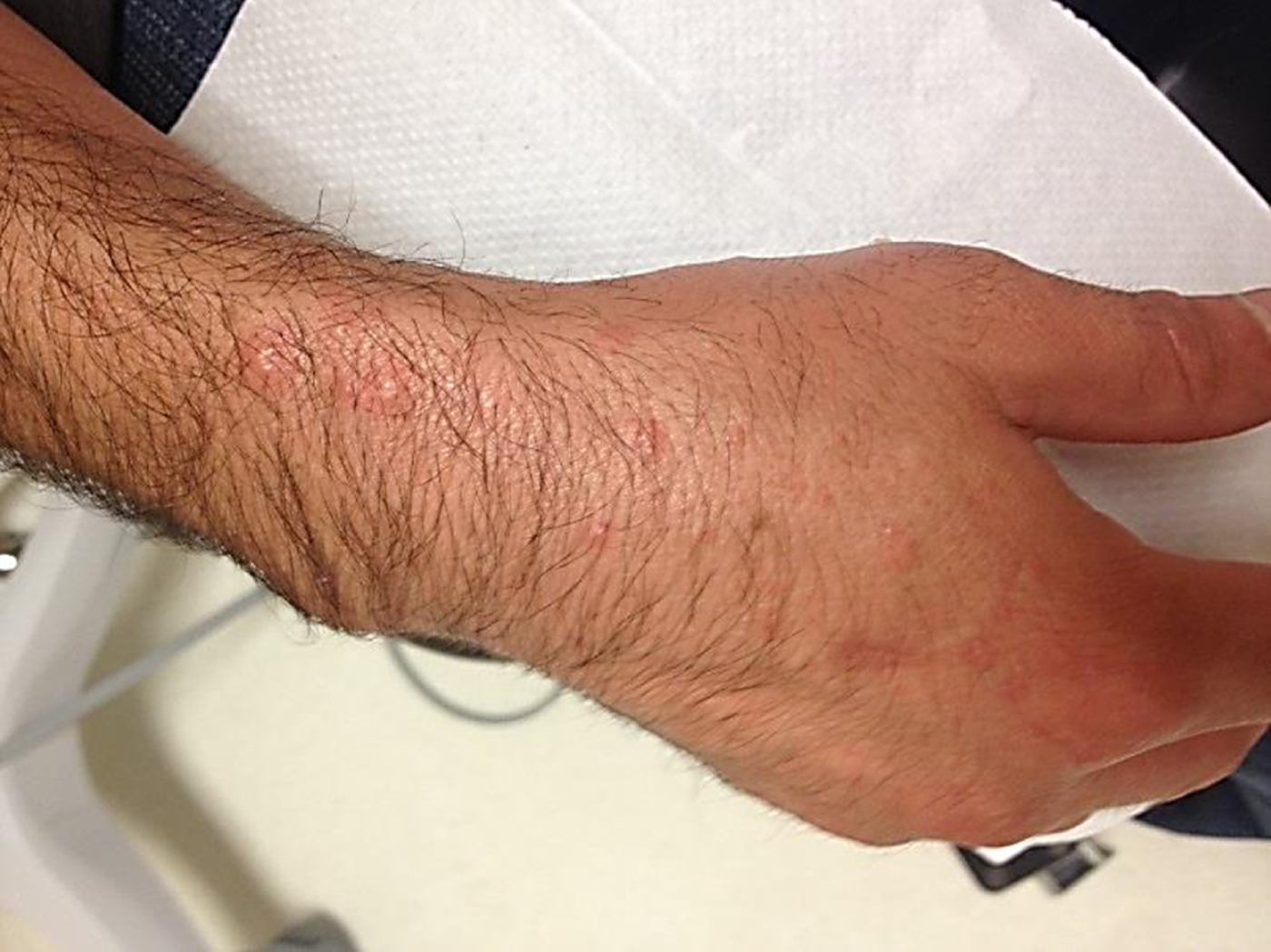 Erythema multiforme after orf virus infection: a report of two cases ...