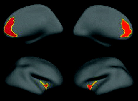 Reality distortion is related to the structure of the salience network ...