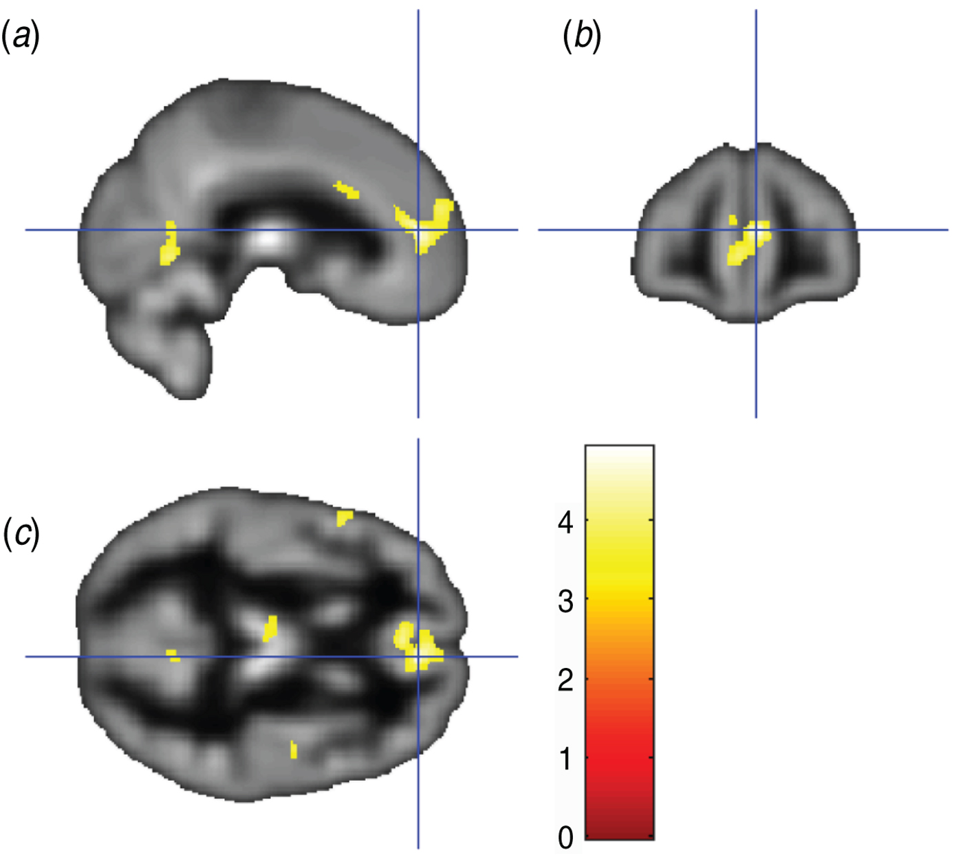 Reduced gray matter volume in the anterior cingulate, orbitofrontal cortex and thalamus as a ...