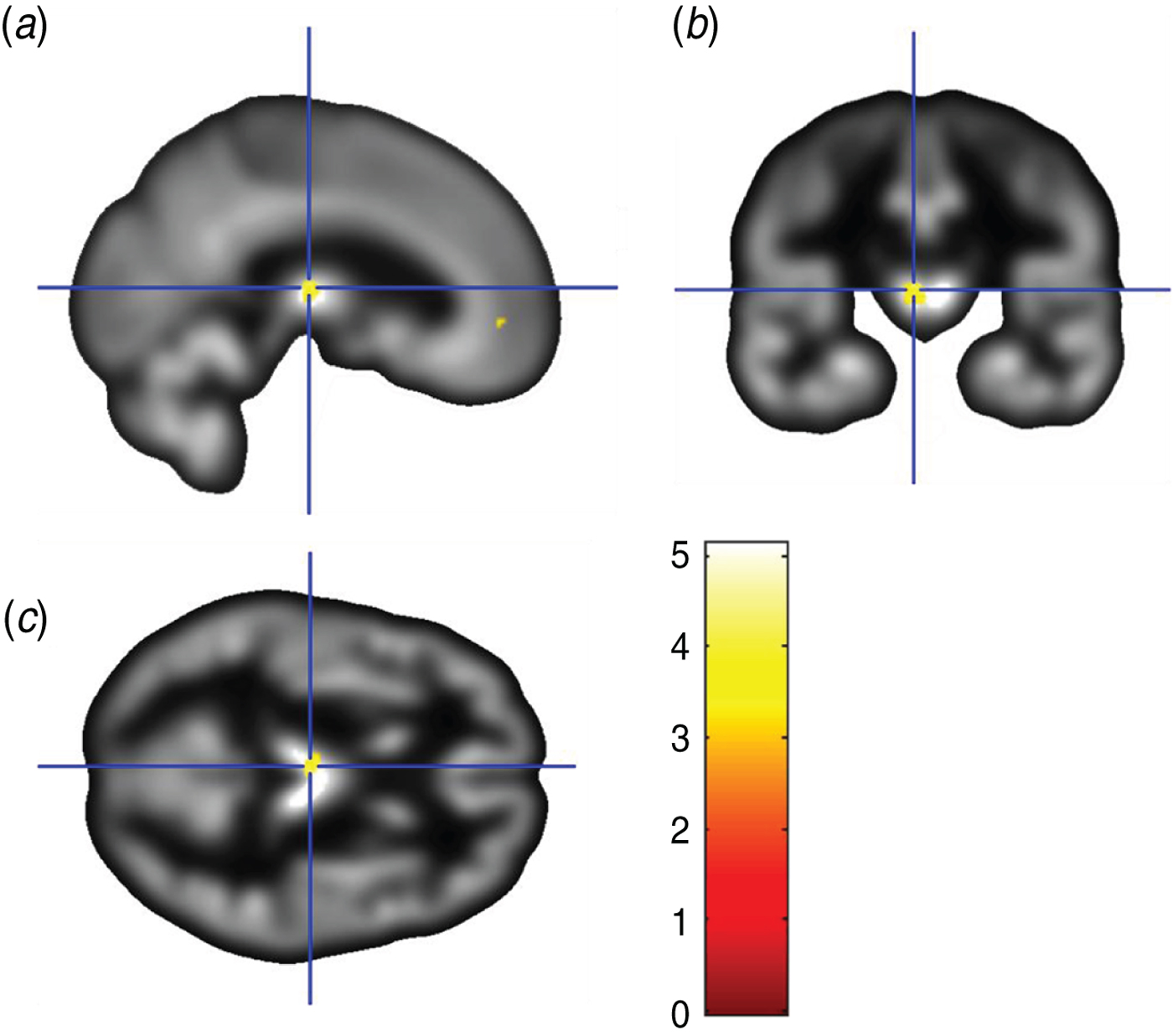 Reduced gray matter volume in the anterior cingulate, orbitofrontal cortex and thalamus as a ...