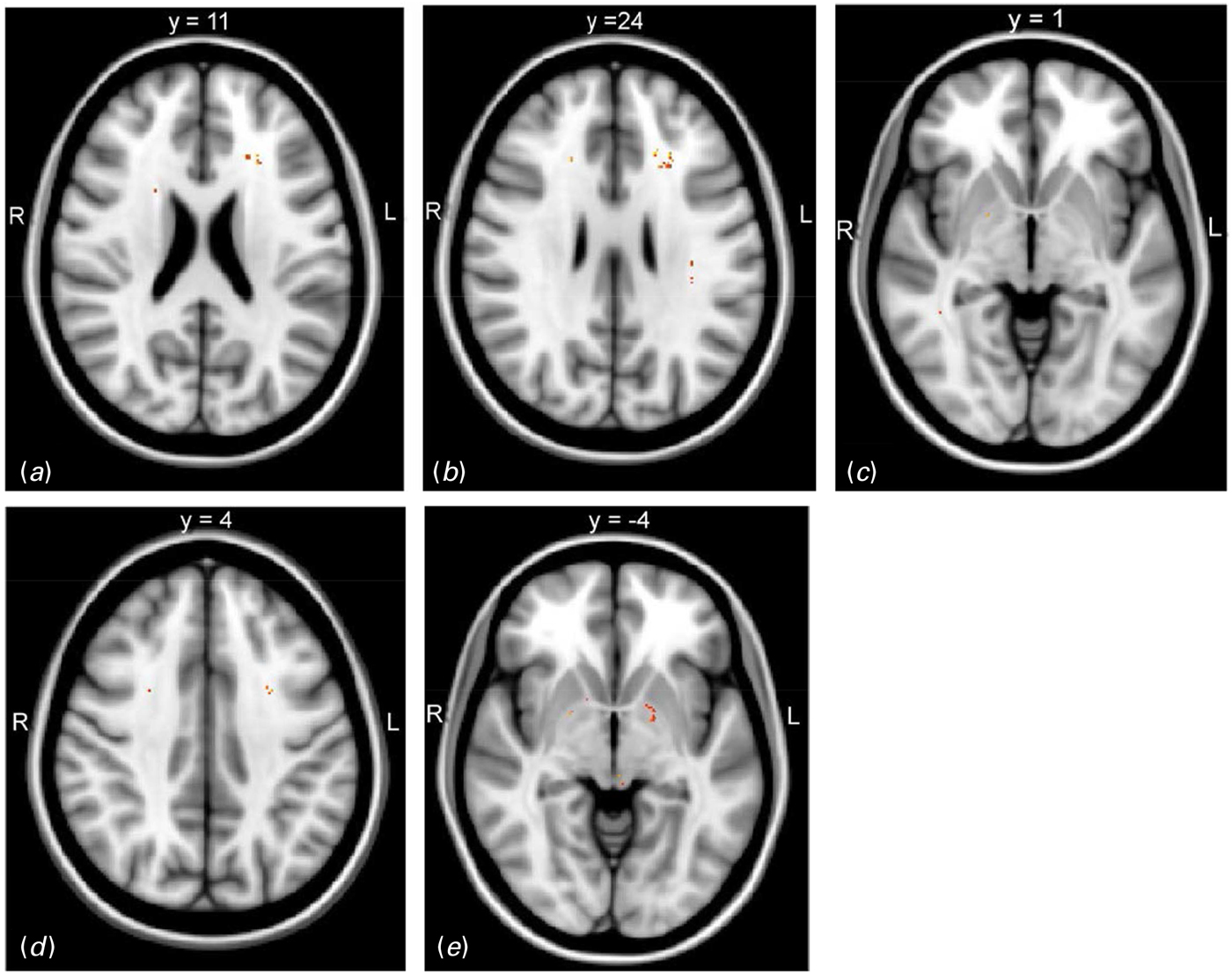 Alterations in white matter micro-integrity of the superior ...