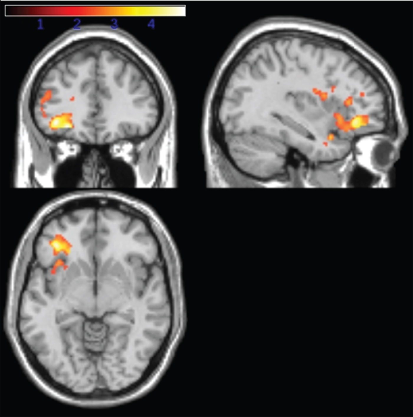 ‘Reading the Mind in the Eyes’: an fMRI study of adolescents with ...