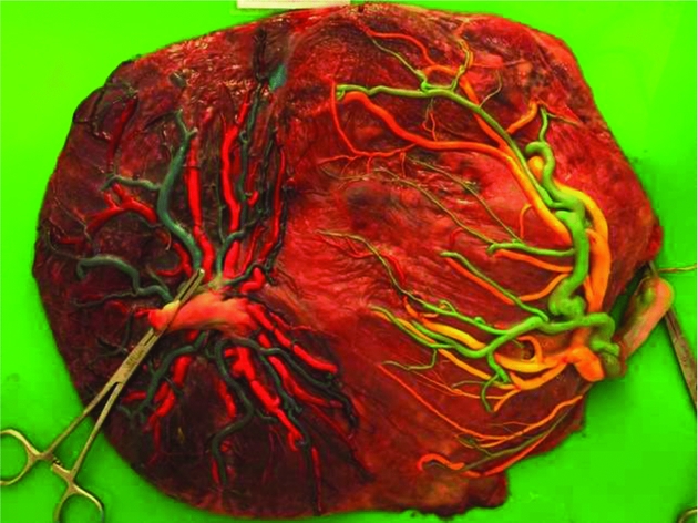 Twin Anemia Polycythemia Sequence: Current Views on Pathogenesis ...