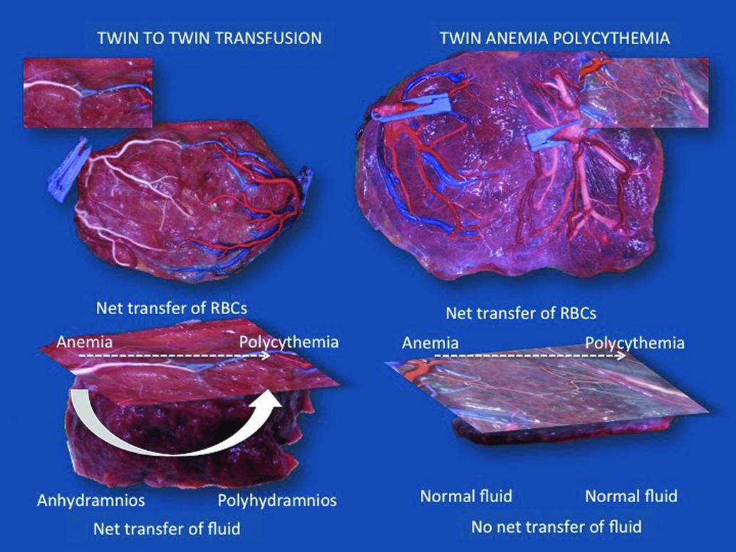 The Placenta in Twin-to-Twin Transfusion Syndrome and Twin Anemia ...