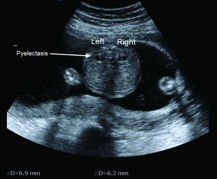GENETIC SONOGRAM: COMPONENTS AND ROLE IN THE ERA OF PRENATAL SCREENING ...