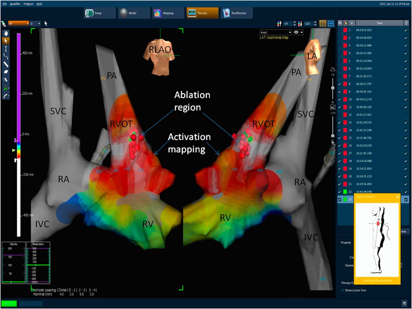 Catheter ablation of idiopathic ventricular tachycardia in children ...