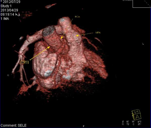 Anomalous right coronary artery from the pulmonary artery (ARCAPA), and ...