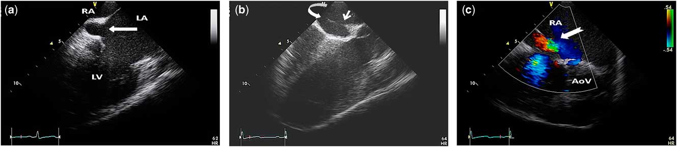 Percutaneous management of coronary sinus atrial septal defect: two ...