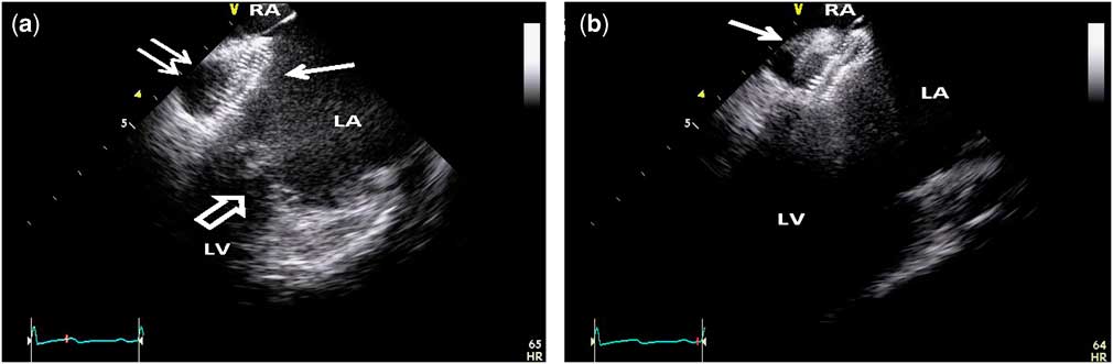 Percutaneous management of coronary sinus atrial septal defect: two ...