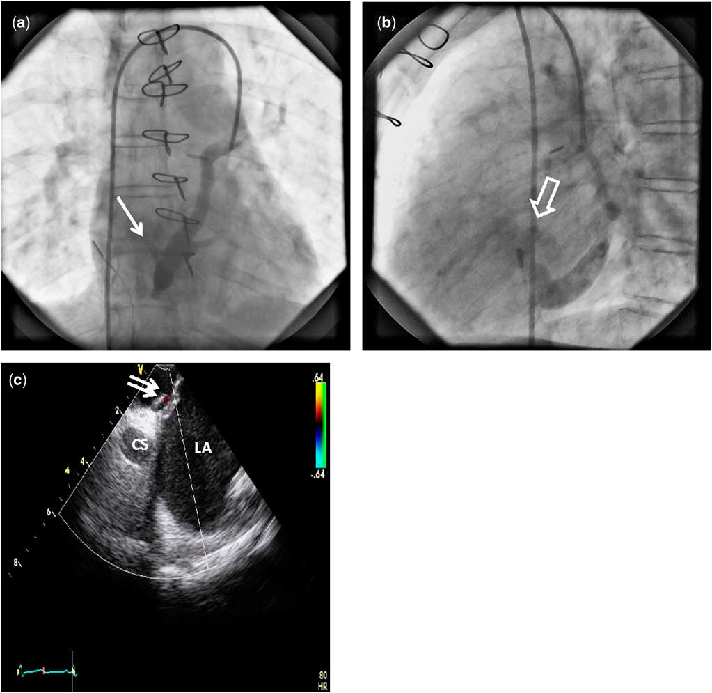 Percutaneous management of coronary sinus atrial septal defect: two ...