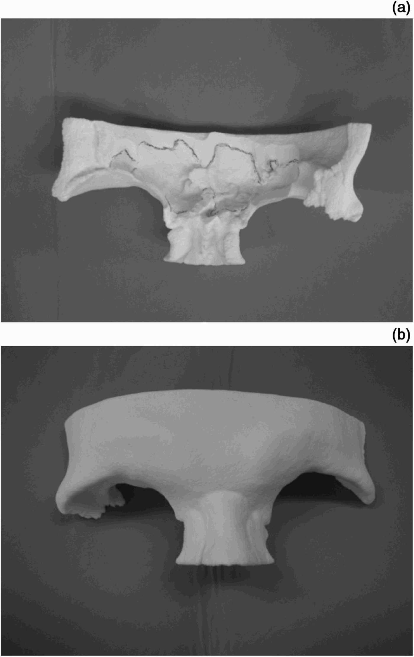 Frontal sinus models and onlay templates in osteoplastic flap surgery ...