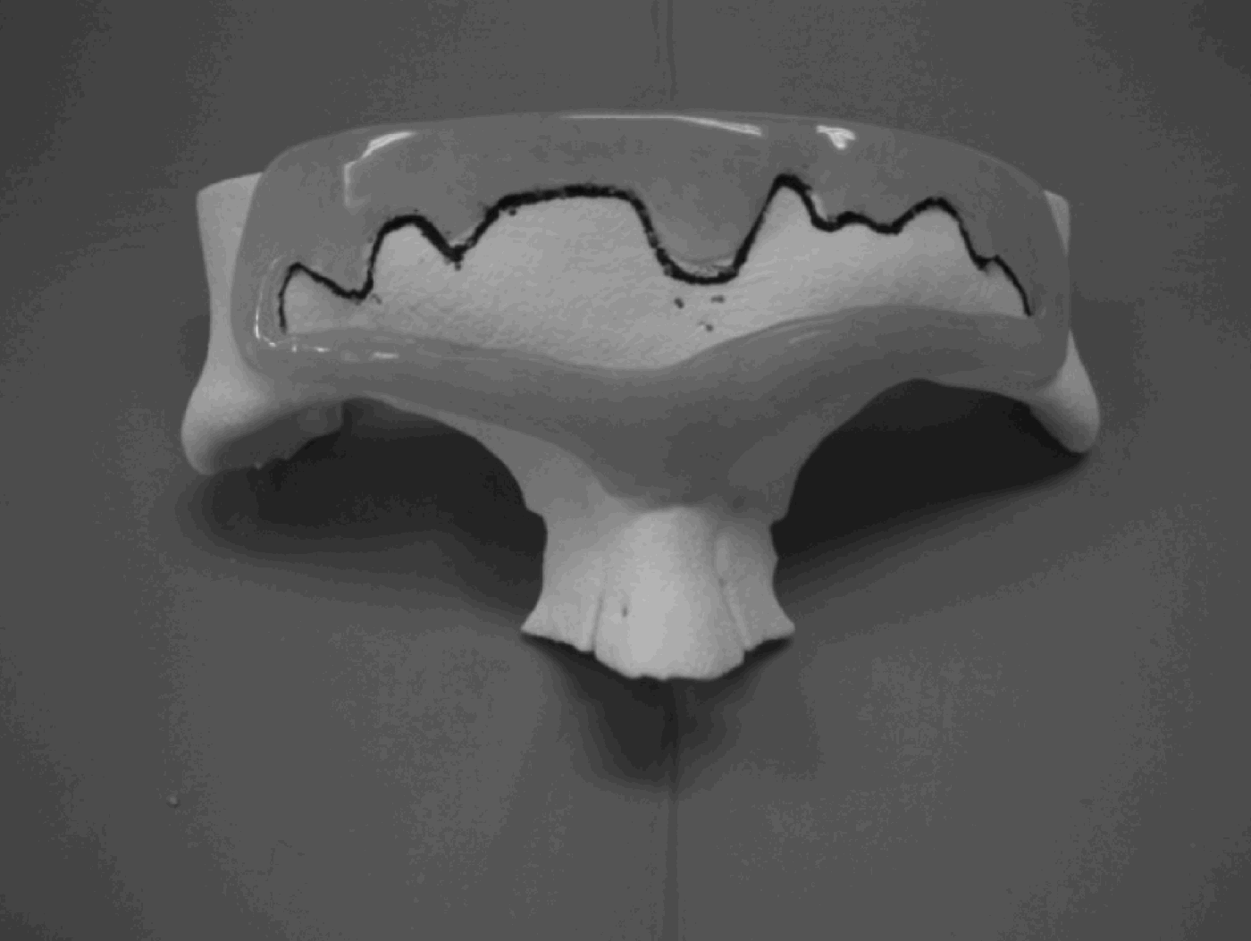 Frontal sinus models and onlay templates in osteoplastic flap surgery ...