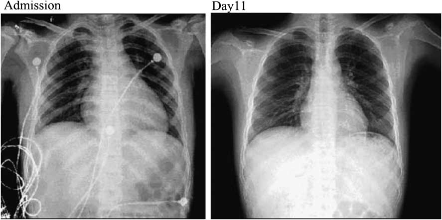 Quick recovery of myocardium damage in a case of subacute thyroiditis ...