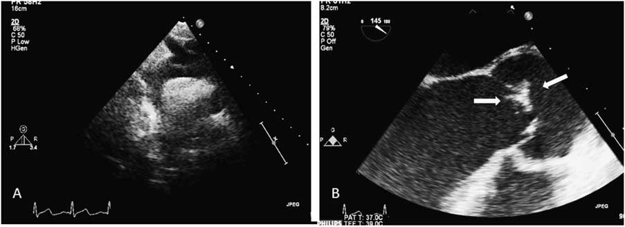 Infective endocarditis, thoracic aortitis, and mycotic aneurysm ...